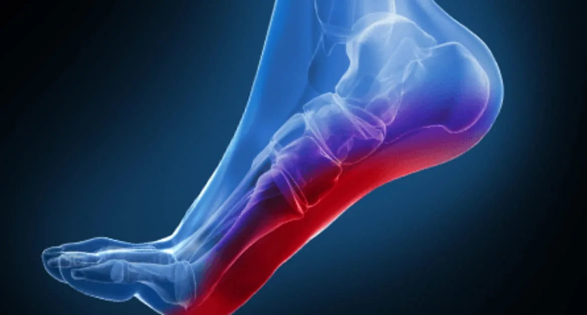 Πελματιαία Απονευρωσίτιδα – ATHLOCLINIC – Δρ. Γιάννης Λεβάκος